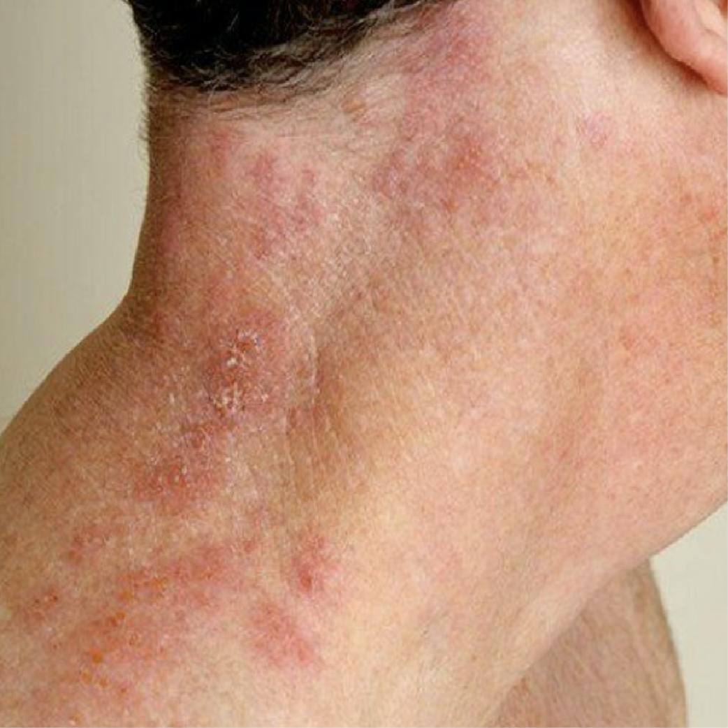 What Does Shingles Look Like Pictues Of Shingles Sympotms On Body Parts
