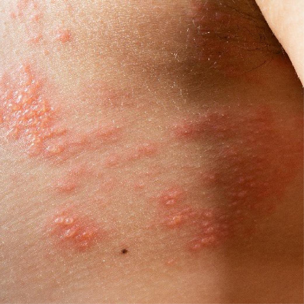 What Does Shingles Look Like? Pictues of Shingles Sympotms on Body Parts