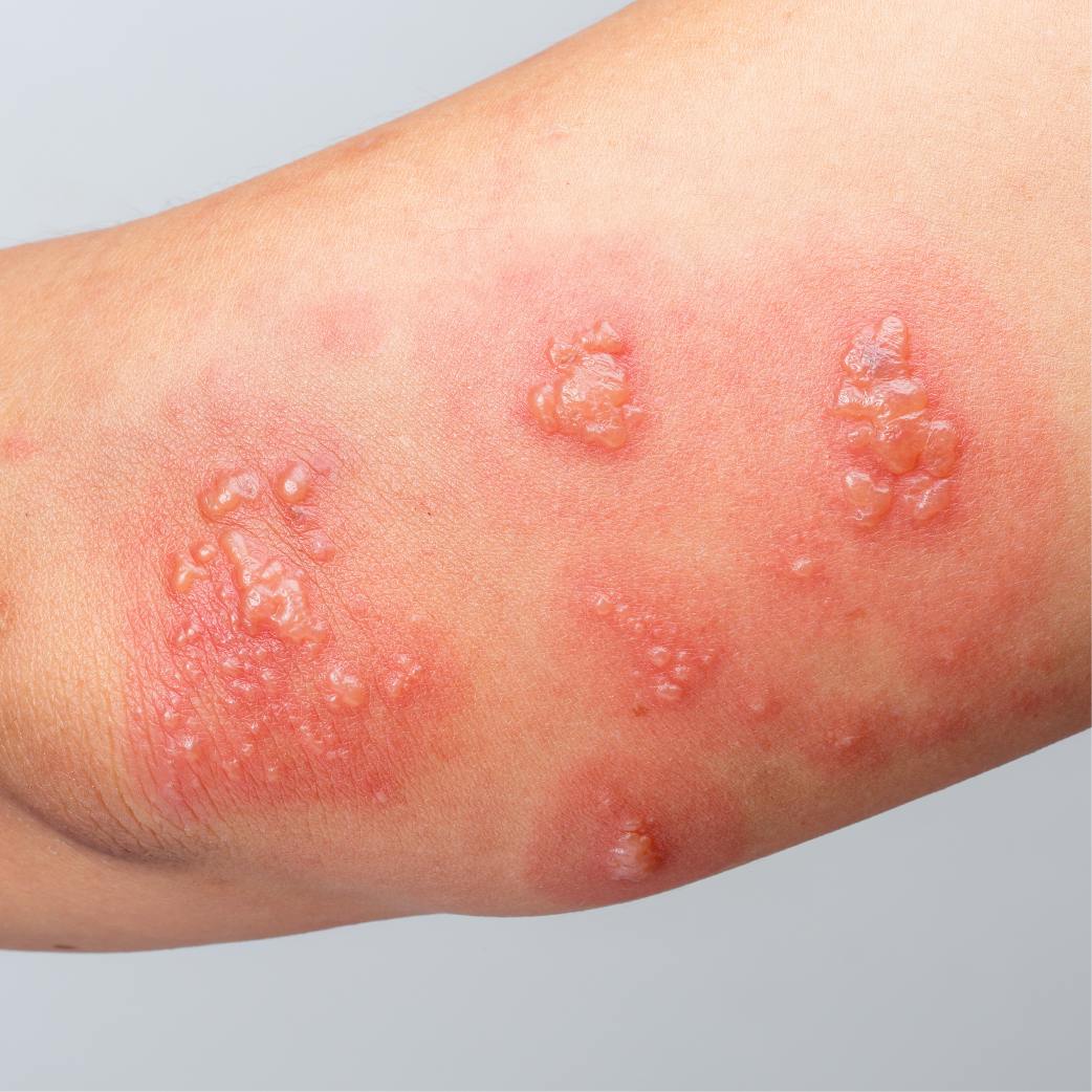 What Does Shingles Look Like? Pictues of Shingles Sympotms on Body Parts